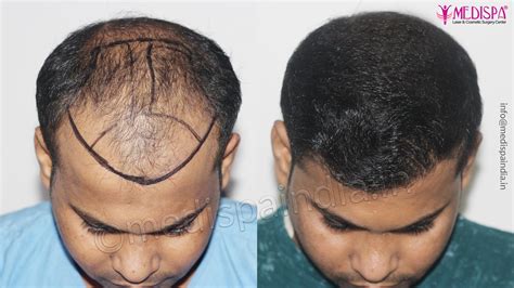 Hair Restoration Jaipur Rajasthan India Hair Transplant Dubai Cost