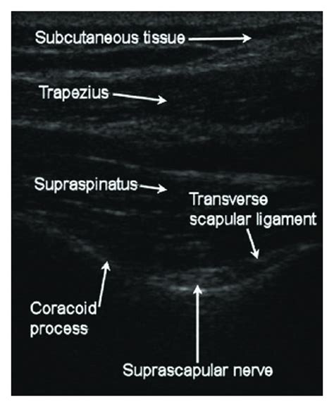 Suprascapular Fossa Scapula An Overview Sciencedirect Topics