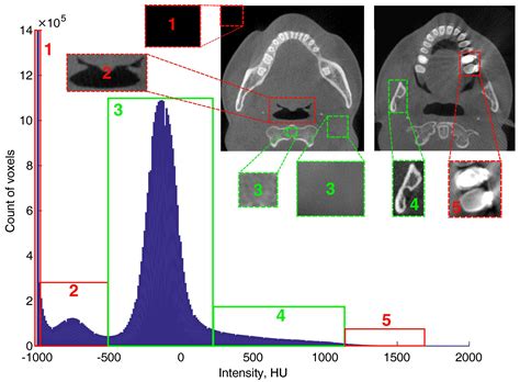 Automatic Method For Bone Segmentation In Cone Beam Computed Tomography Data Set