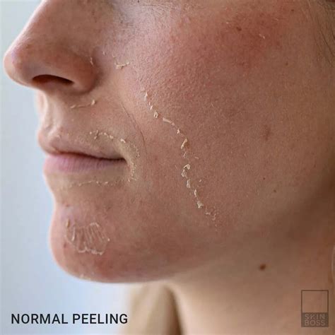 Burn Spots After Chemical Peel Why When They Happen