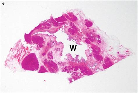 Papillary Mucinous Neoplasm Ipmn Radiology Key