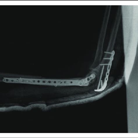Screw Fixation Of Olecranon Osteotomy Download Scientific Diagram