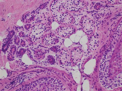Ffs Hande 20× Magnification Note The Predominance Of Clear Cells With