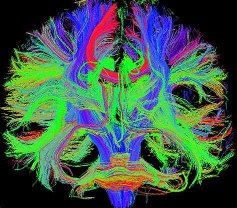 Diffusion Mri Mapping The Structural Highways Of The Brain Neuwrite San Diego