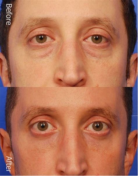 Blepharoplasty — Sky Facial Plastic Surgery