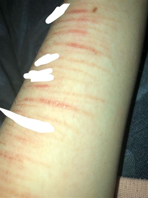 What Is This Red Streak Going Up My Inner Arm Recent Sh Blurred Out