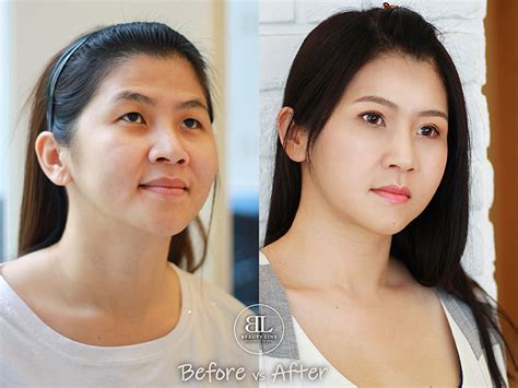 【內視鏡前額拉皮 X 割雙眼皮 X 玻尿酸精雕】連本人都不敢相信的蛻變真實記錄 真實案例分享 最新消息 美麗線時尚診所 台中