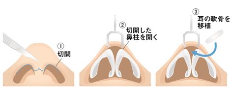 鼻中隔延長 Venus Beauty Clinic（新宿・銀座）