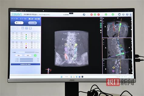京汉专家合作，完成湖北首台骨科机器人5g远程手术中国机器人网