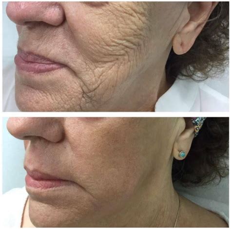 Peeling Químico Clínica Inderma