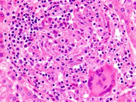 Pathological Appearance Of The Liver Granulomas The Granulomas Were
