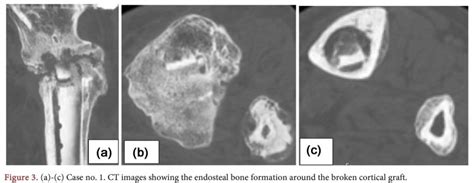 Scientific Research Publishing On Linkedin Pseudarthrosis Bone Infection Bone Grafting
