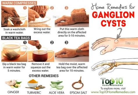 Más De 25 Ideas Increíbles Sobre Ganglion Cyst Wrist En Pinterest