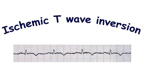 T Wave Inversion