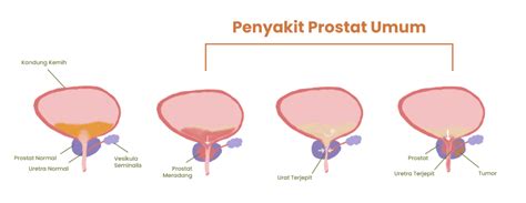 3 Masalah Prostat Yang Umum Terjadi Pada Pria