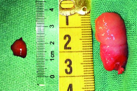 Different Size And Aspect Of Polyps And Their Implantations Download Scientific Diagram