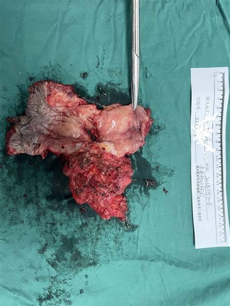 陈贵平主任：空盆腔综合征手术分享