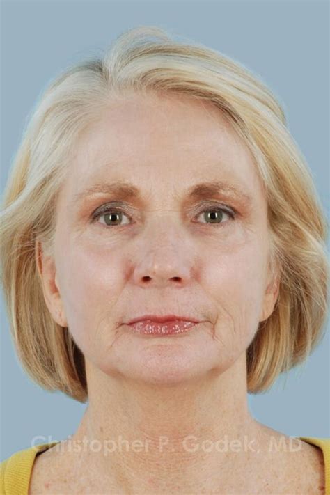 Before And After Laser Resurfacing In New Jersey The Godek Center