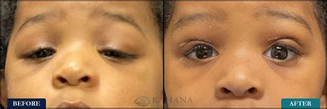 Congenital Ptosis Surgery Before And After