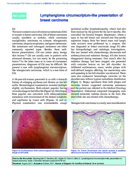 Pdf Lymphangioma Circumscriptum Like Presentation Of Breast Carcinoma