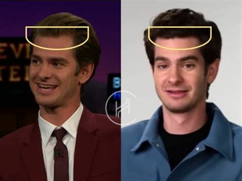 Andrew Garfield Hair Transplant Hair Loss And Technical Analysis
