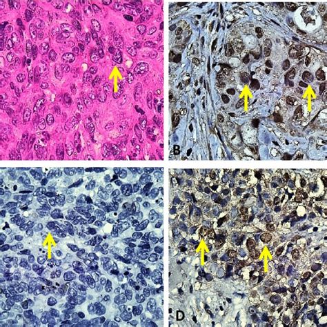 Histopathologic Feature Of Npc And P16 Expression In Npc Patients And