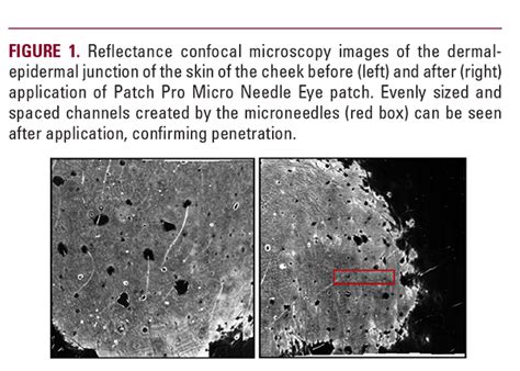 In Vivo Reflectance Confocal Microscopy Evaluation Of Microneedle Patch