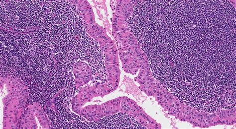 Warthin Tumor Concomitant With Mantle Cell Lymphoma A Case Report And