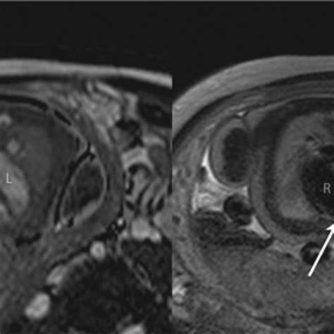 Comparison Of Cine Mri Methods Applied To The Human Fetal Heart