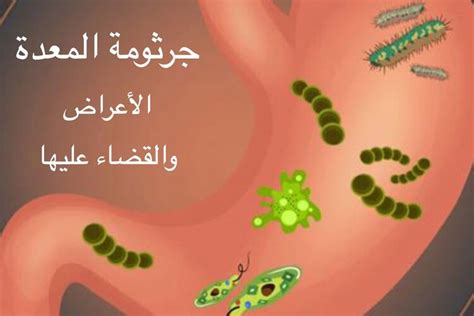 علاج جرثومة المعدة بالأعشاب طرق طبيعية لتخفيف الأعراض