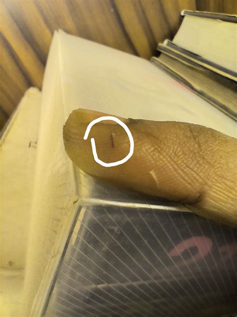 A Really Tiny Wooden Splinter Is Stuck In The Skin R Fixit