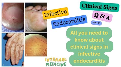 Clinical Signs In Infective Endocarditis A Comprehensive Visual Presentation Youtube