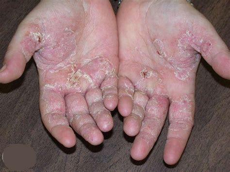 Mild Contact Dermatitis On Hands