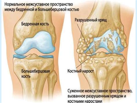 Гонартроз Артроз колінного суглобу гонартроз деформуючий артроз презентация онлайн