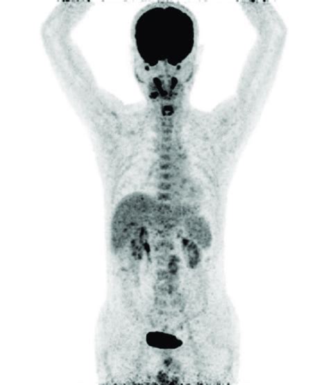 No Obvious Abnormal Fdg Uptake Area Was Displayed Except For The