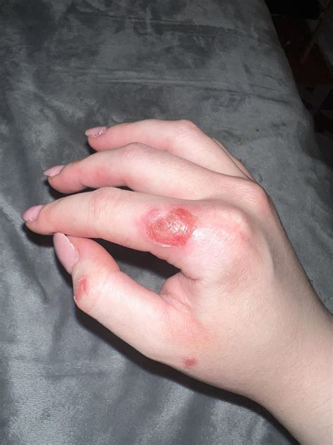 Please Help Possible Mrsa Rmrsa