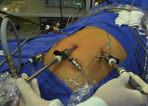 Conventional Laparoscopic Cholecystectomy Download Scientific Diagram