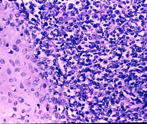 Mesenchymal Chondrosarcoma Tumor Surgery Network