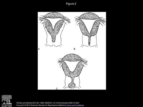 Congenital Anomalies Of The Uterine Cervix Lessons From Cases Managed Clinically By A Common