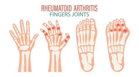 Artritis Reumatoide Osteoartritis De Las Articulaciones De Los Dedos De