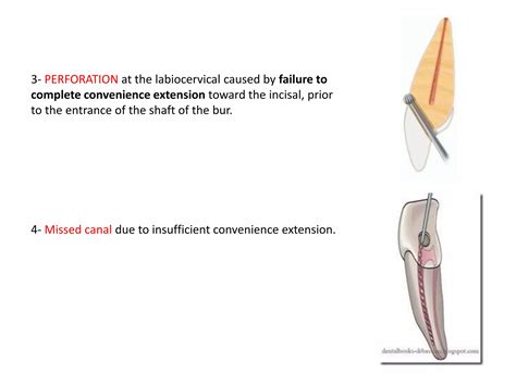 Access Cavity Preparation Pptx