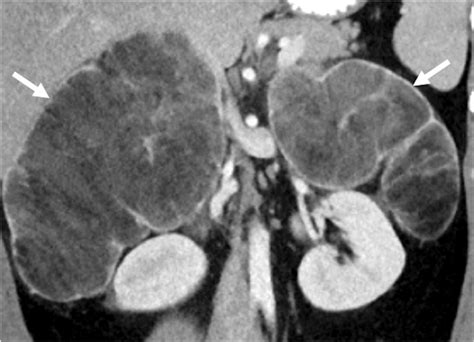 Congenital Adrenal Hyperplasia Xy At Eliza Coles Blog