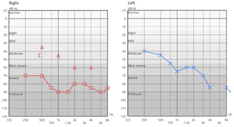 What Actually Is An Audiogram Veritas Hearing Uk