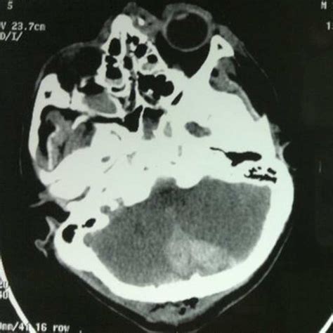 Posterior Fossa Craniectomy And Foramen Magnum Decompression Showing Download Scientific