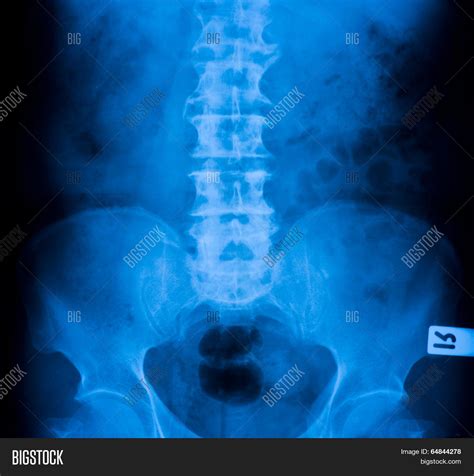 X Ray Pelvis Spinal Image Photo Free Trial Bigstock