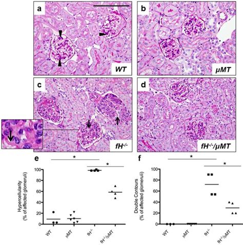 Igm Exacerbates Glomerular Disease Progression In Complement Induced Glomerulopathy Pmc
