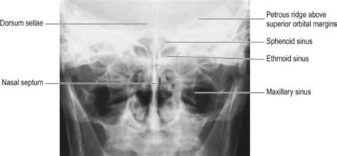 Paranasal Sinuses Radiology Key