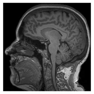 An Example Of The Brain Mri Segmentation With An Original Mr Image A