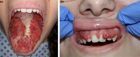 Pyostomatitis Vegetans Causes Symptoms Diagnosis And Treatment