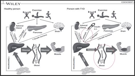 Intricacies Of Physical Exercise In Type 1 Diabetes Cme India